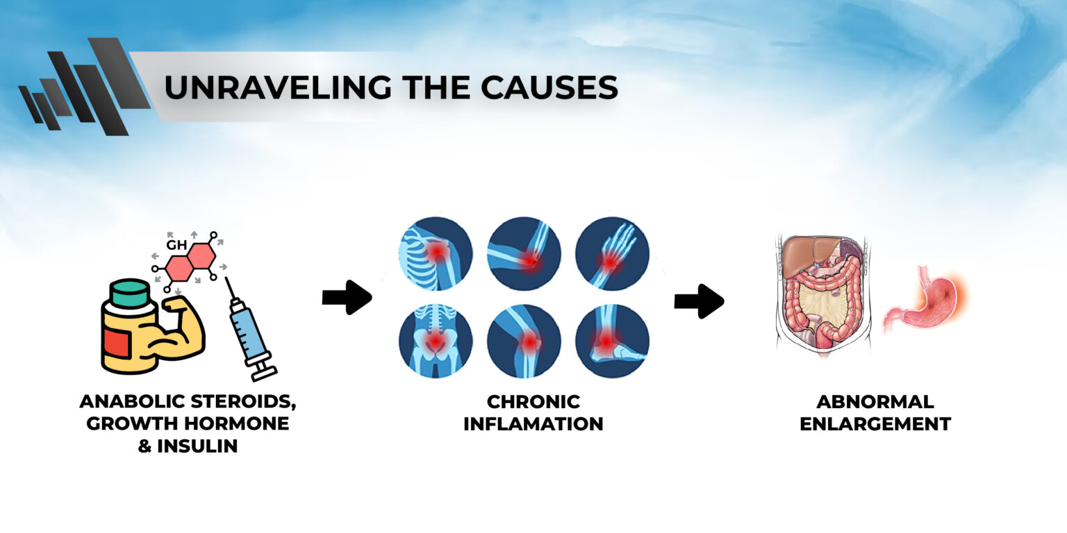 Roid Gut Revealed: Understanding Palumboism